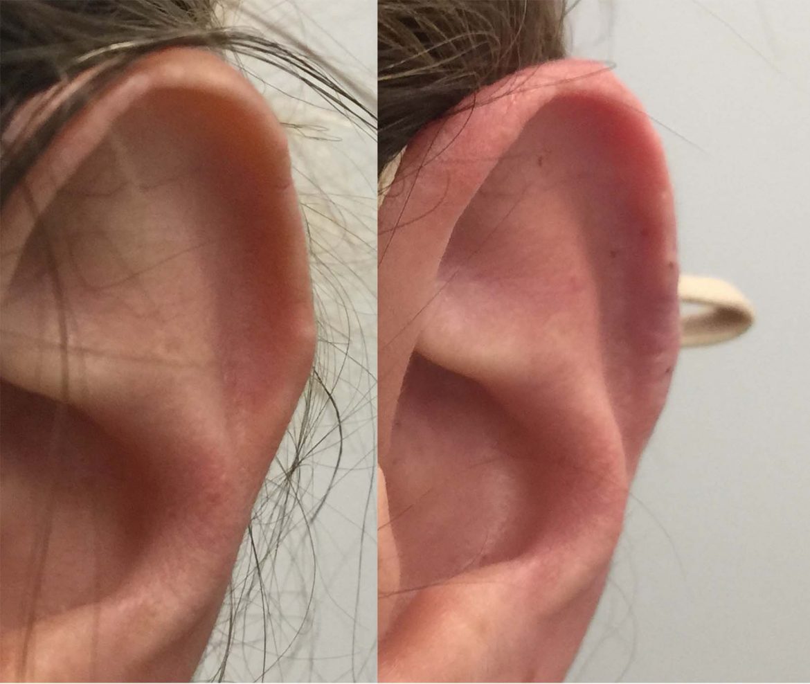 Ear Lobe Cosmetic Repair Clinic | Eatons Quality Medical Center