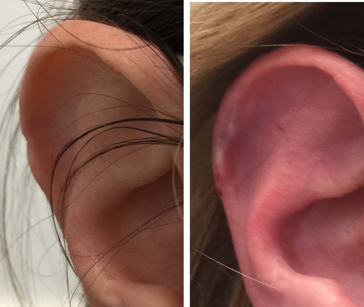 Ear Lobe Cosmetic Repair Clinic | Eatons Quality Medical Center